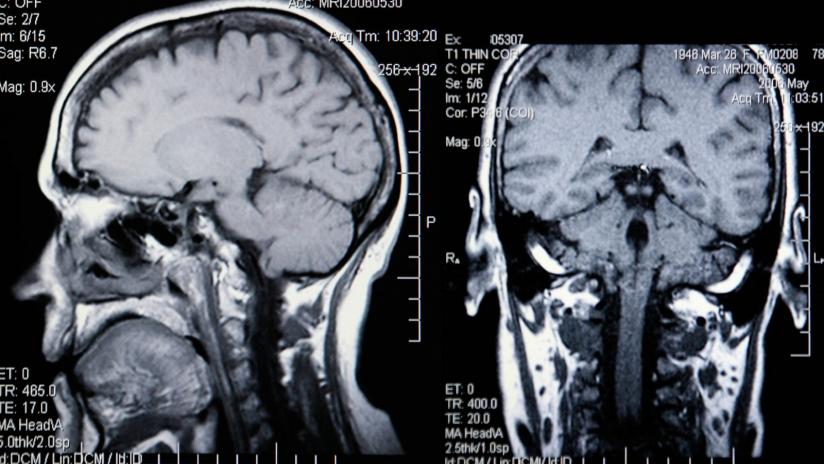 Lobotomia, pagina buia della medicina con tanto di Nobel - Paginemediche